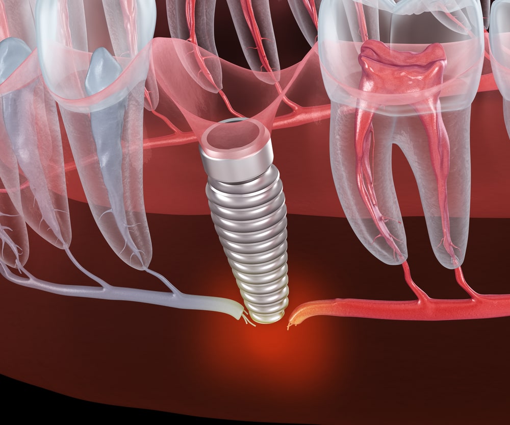 Failed Dental Implants | Peri-Implantitis Treatment