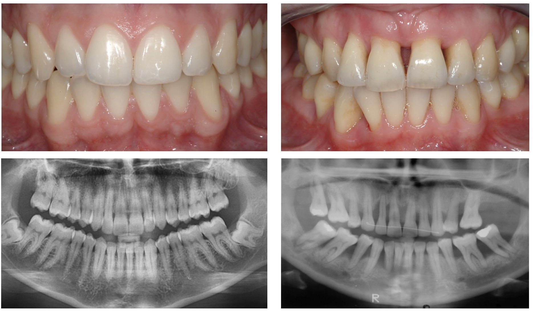 Gum Disease Treament | Advanced Dentistry