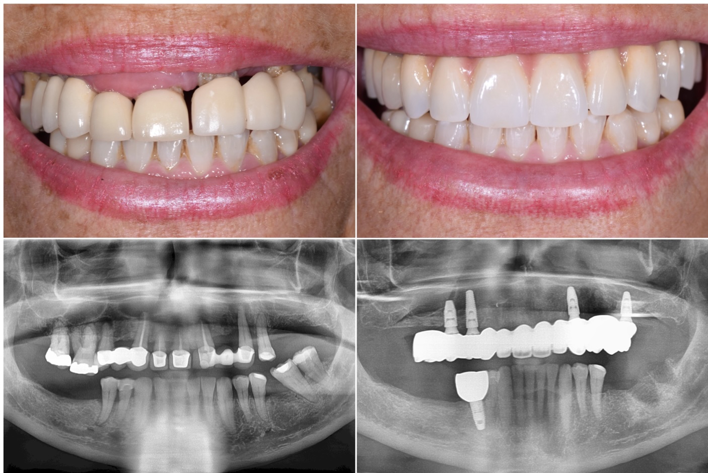 All On 4 Dental Implants Before And After