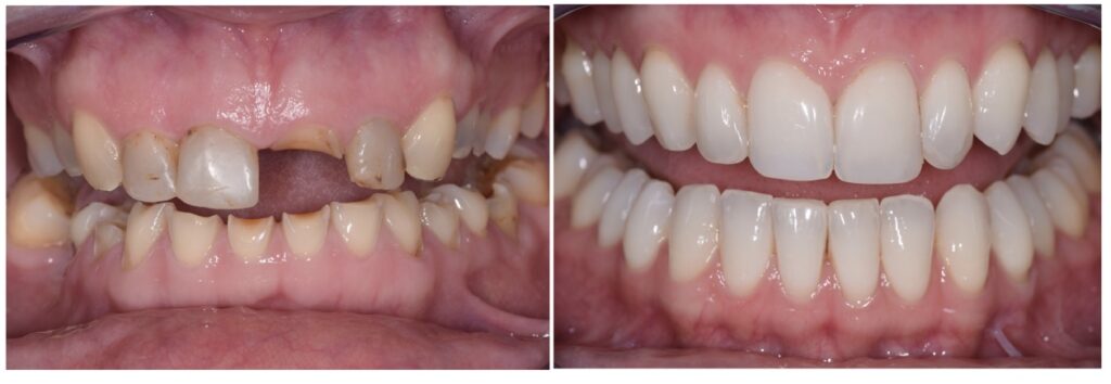 Worn Teeth | How to Treat Worn Down Teeth